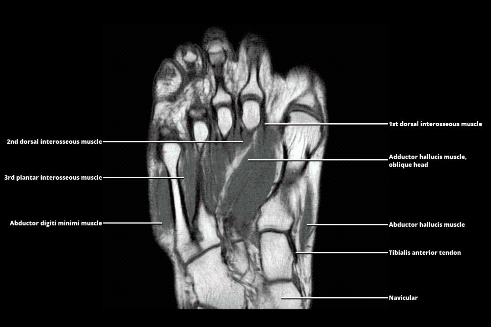 MRI FOOT MRI FOOT
